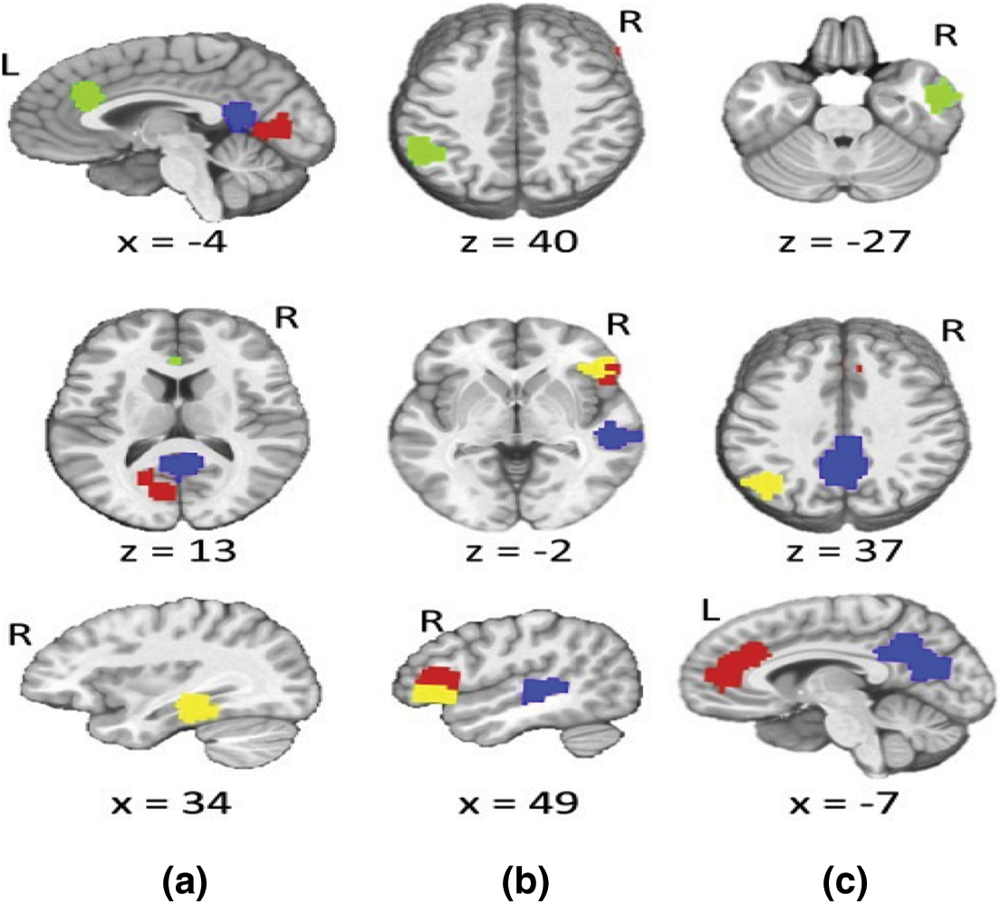Conditional Generative Adversarial Network Approach for Autism Prediction