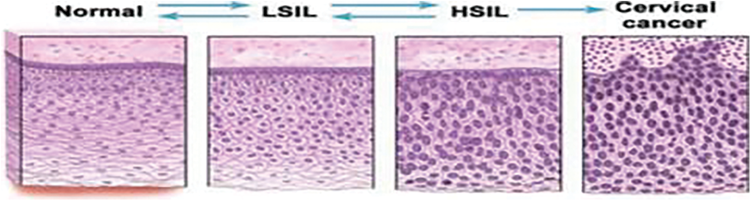 Cervical Cancer Detection Based on Novel Decision Tree Approach