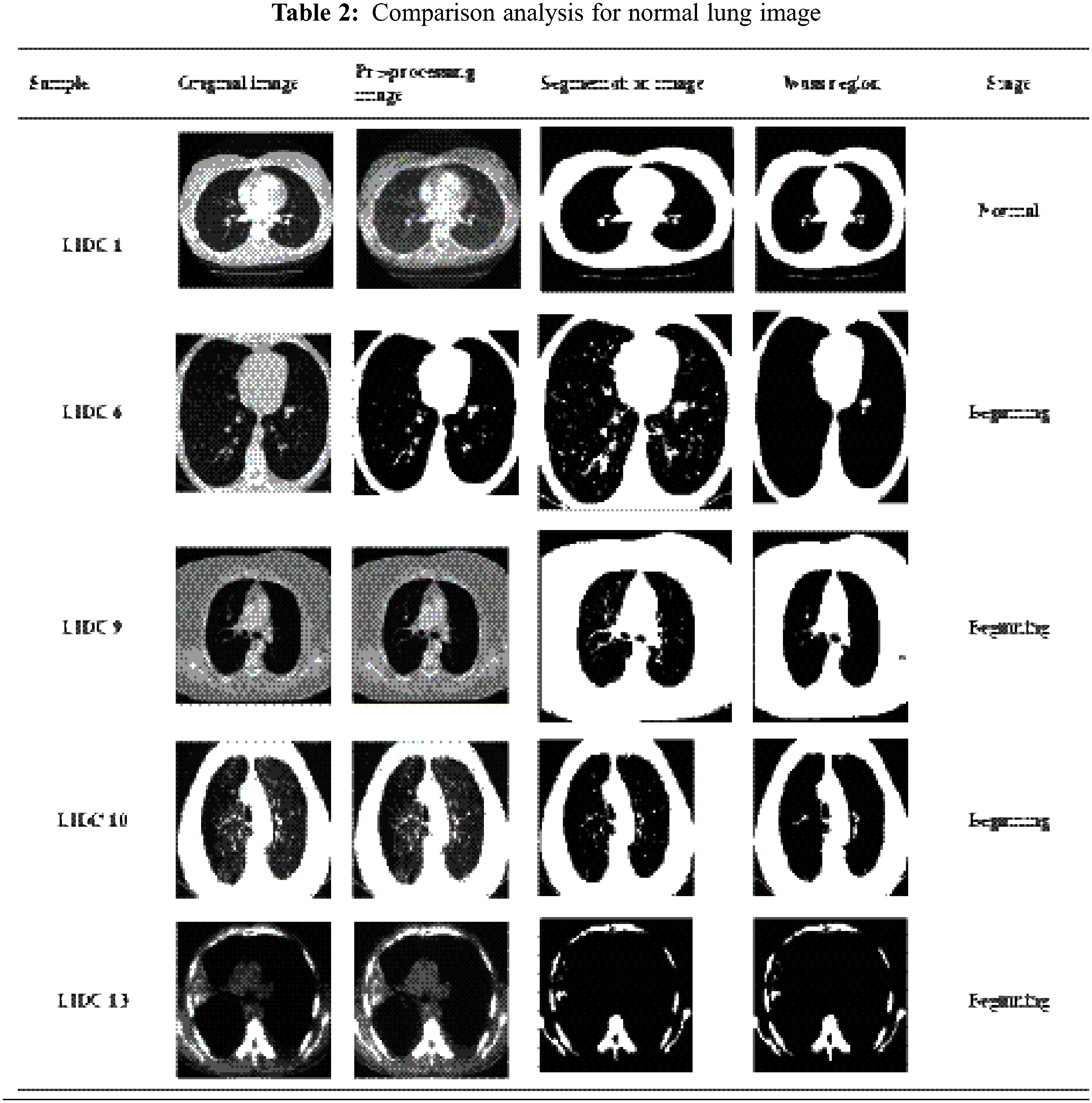 Novel Contiguous Cross Propagation Neural Network Built CAD for Lung Cancer