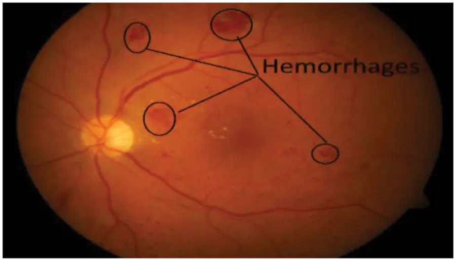 Detection and Classification of Hemorrhages in Retinal Images