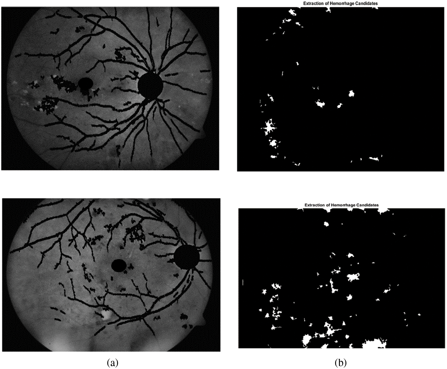 Detection and Classification of Hemorrhages in Retinal Images