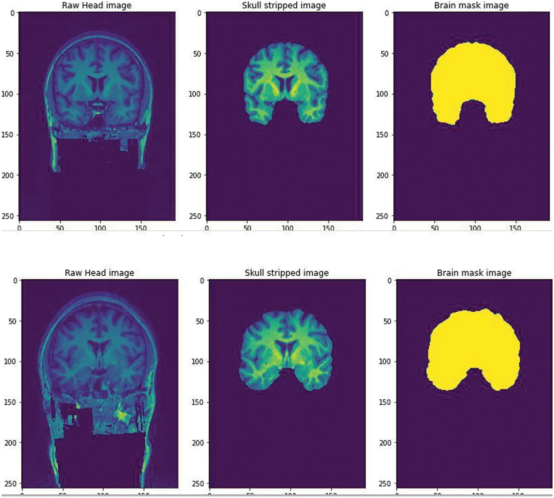A Novel Segment White Matter Hyperintensities Approach for Detecting ...