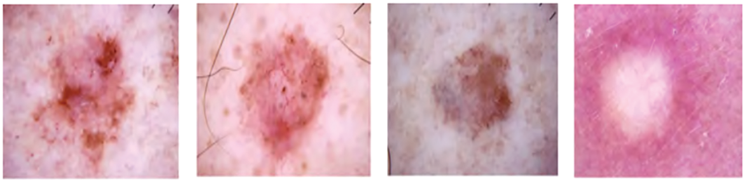 Regularised Layerwise Weight Norm Based Skin Lesion Features Extraction ...