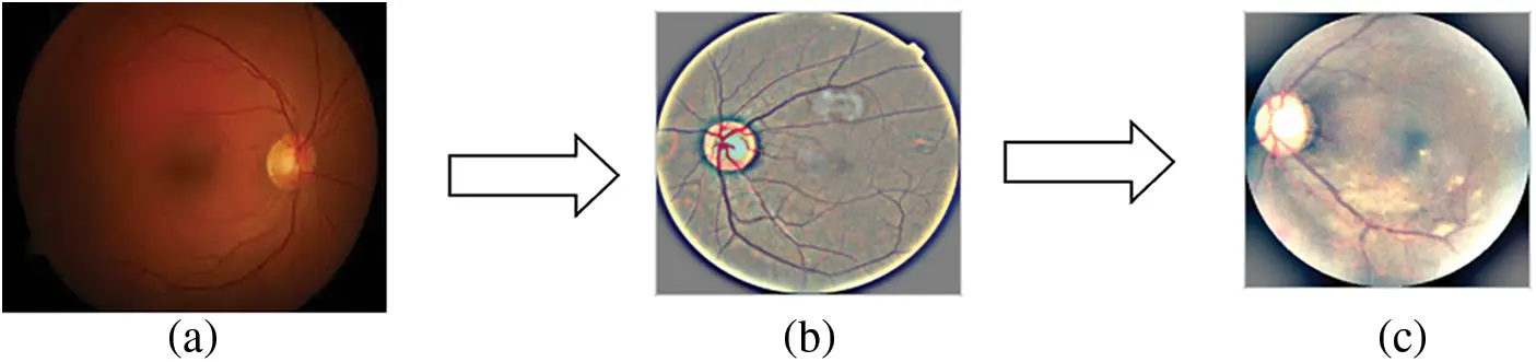CSSE | Free Full-Text | Detection of Diabetic Retinopathy from Retinal ...