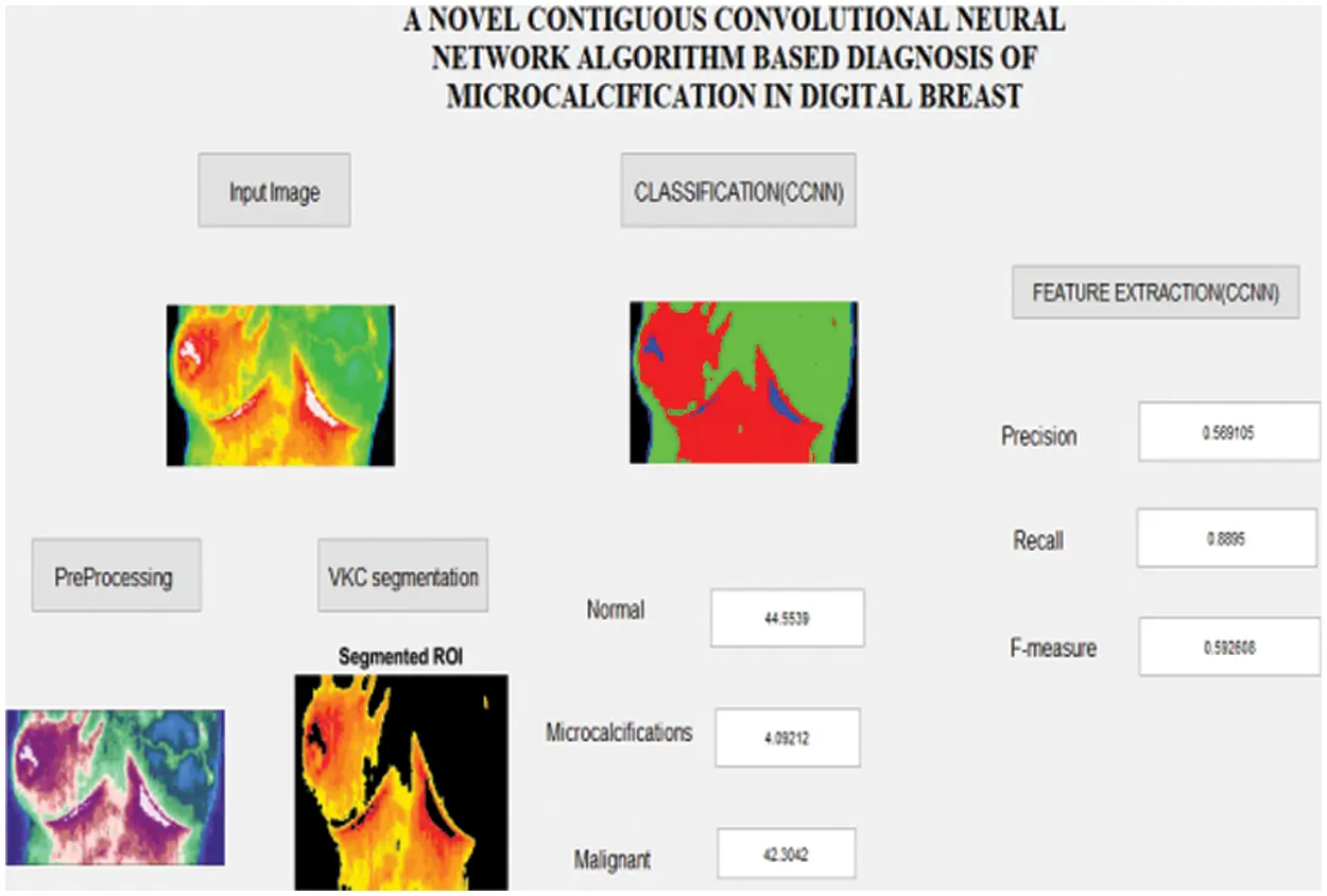 CSSE | Free Full-Text | Micro Calcification Detection in Mammogram Images Using Contiguous ...