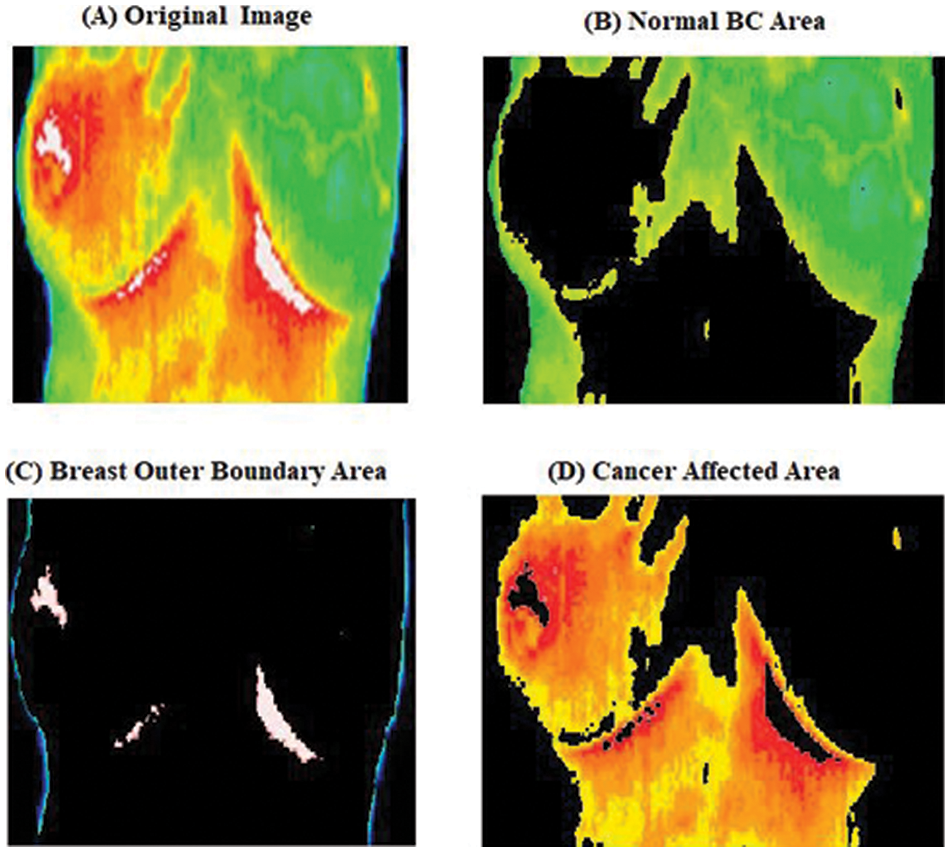 CSSE | Free Full-Text | Micro Calcification Detection in Mammogram ...