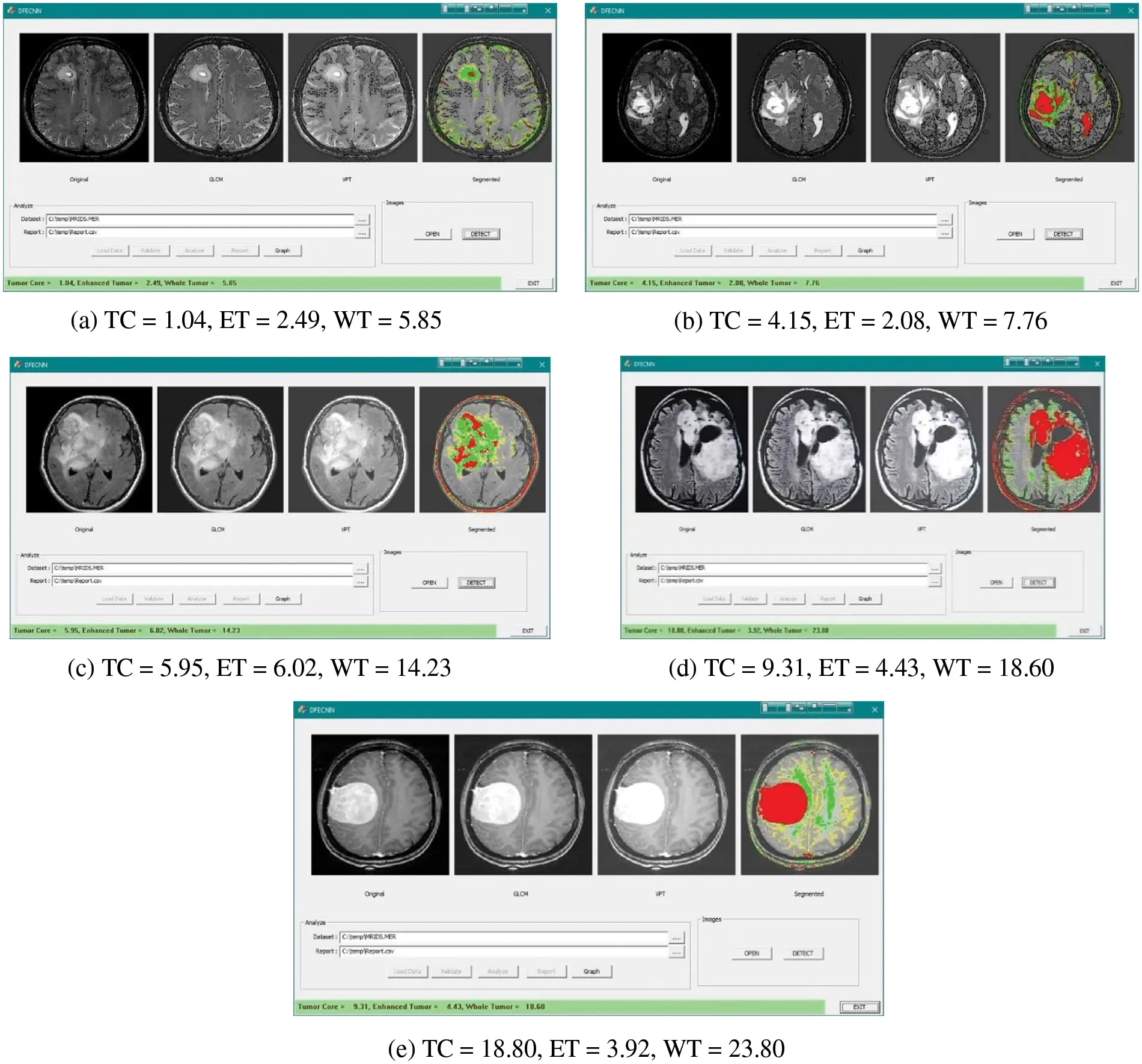 CSSE | Free Full-Text | Brain Tumor: Hybrid Feature Extraction Based on UNet and 3DCNN