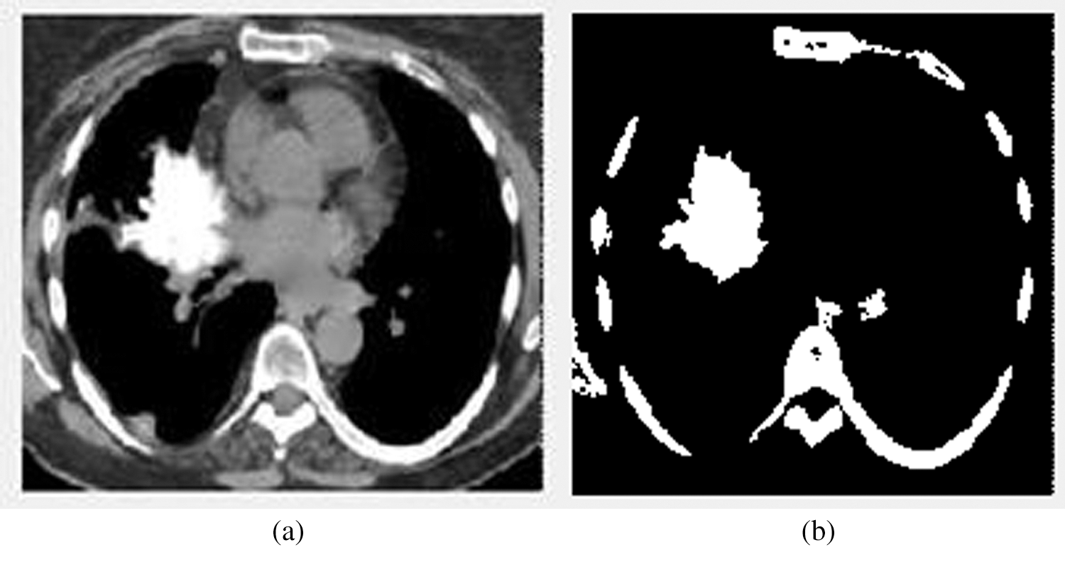 Multi-Model Detection of Lung Cancer Using Unsupervised Diffusion ...