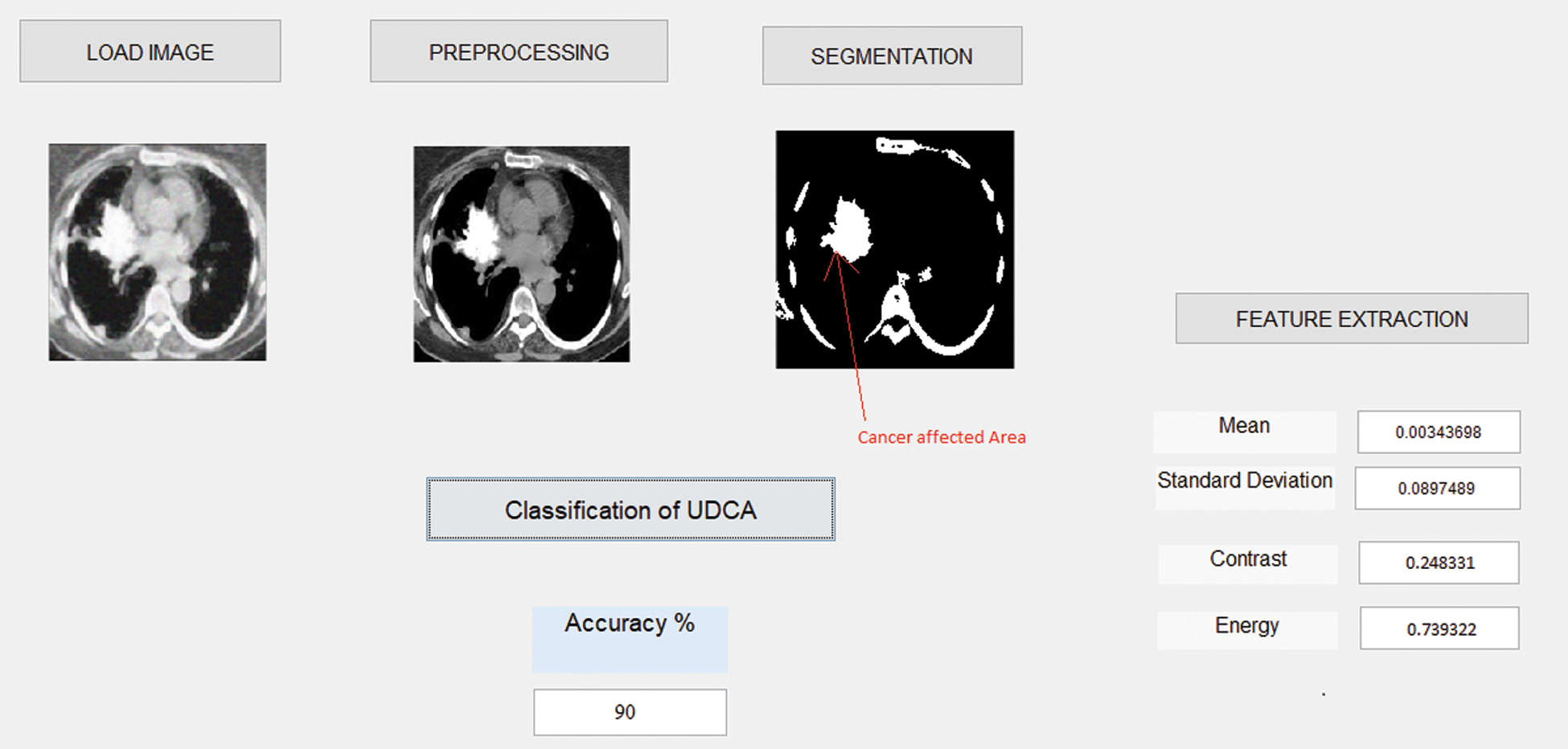 Multi-Model Detection of Lung Cancer Using Unsupervised Diffusion Classification Algorithm