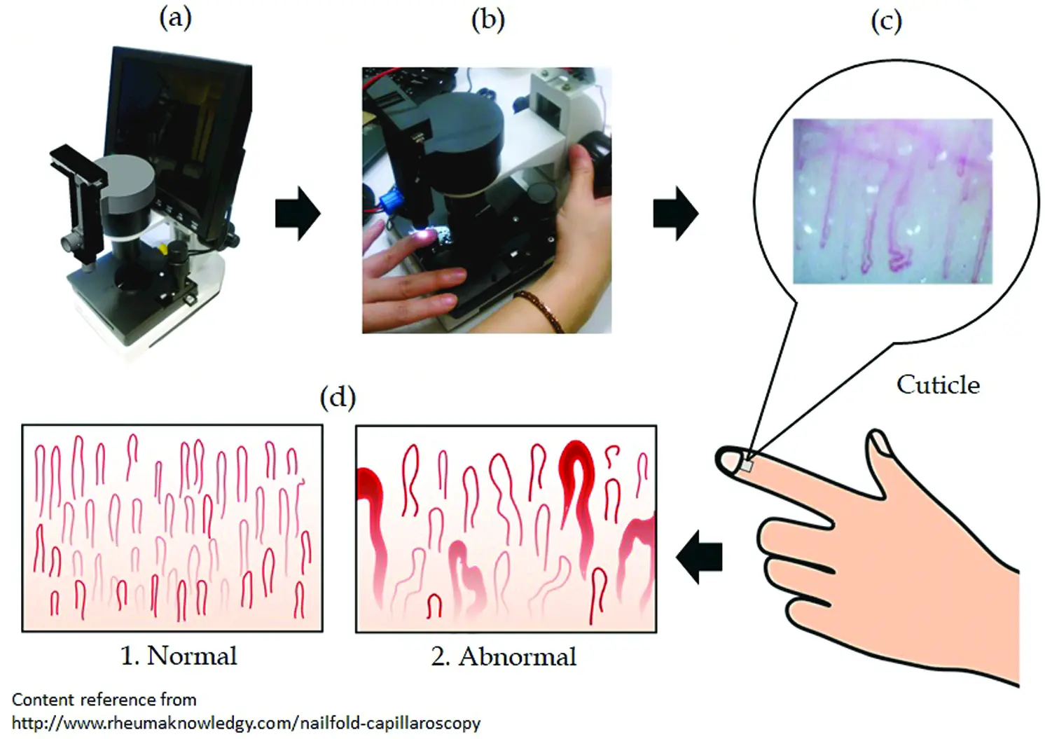 Applying t-SNE to Estimate Image Sharpness of Low-cost Nailfold ...