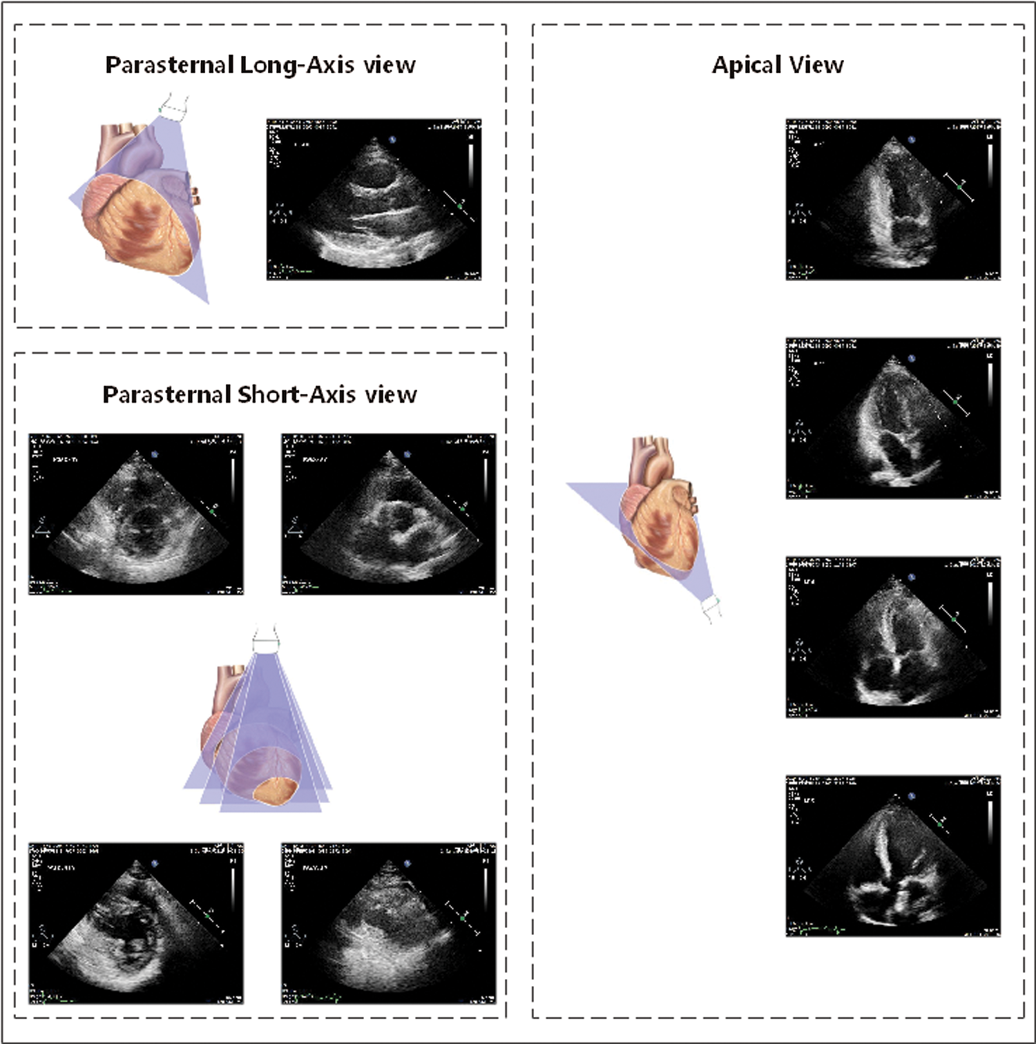 Classification of Echocardiographic Standard Views Using a Hybrid ...