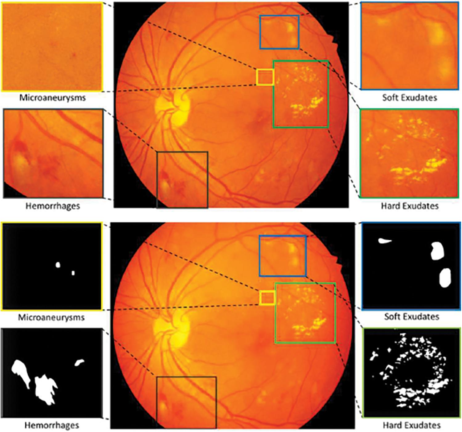 Detection of Diabetic Retinopathy Using Custom CNN to Segment the Lesions