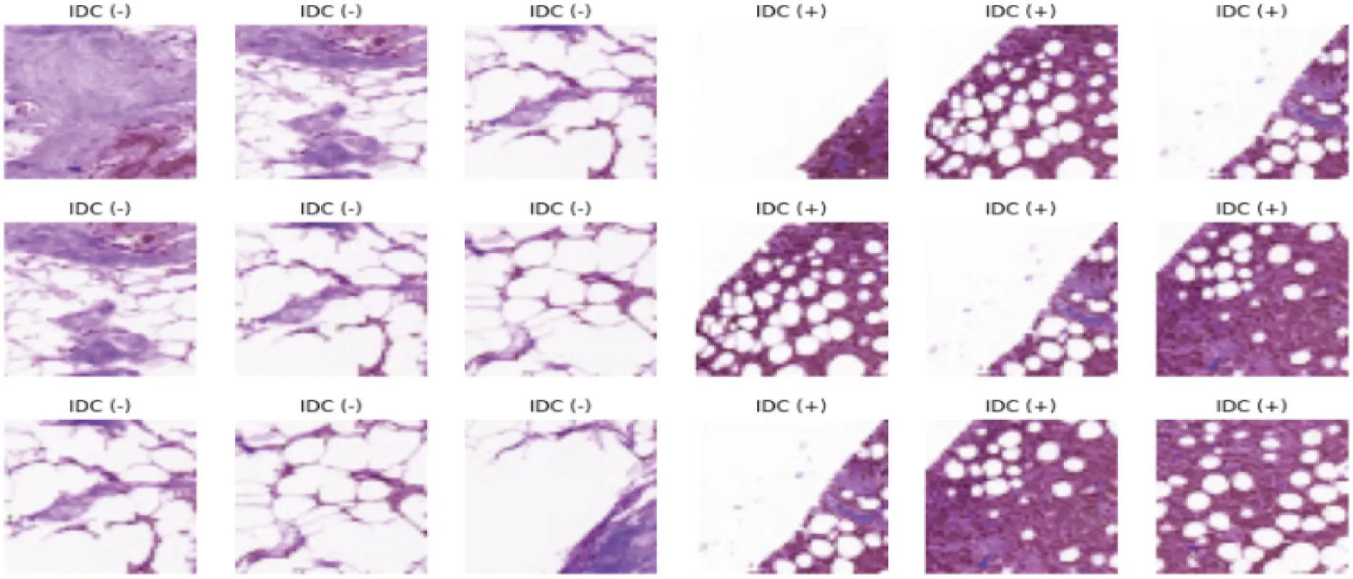 A Stacked Ensemble-Based Classifier for Breast Invasive Ductal ...