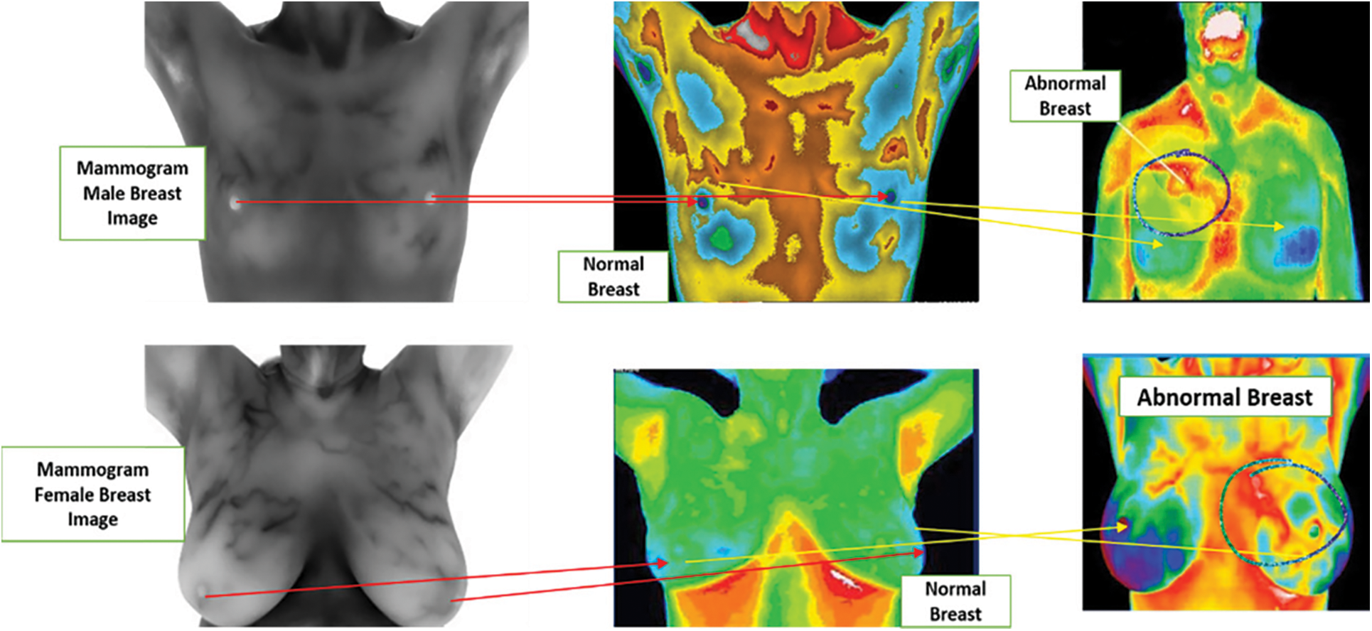 CAD of BCD from Thermal Mammogram Images Using Machine Learning