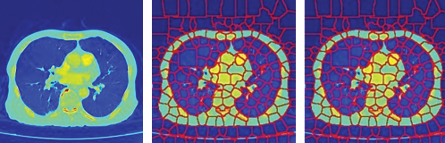 A Novel Deep Learning Framework for Pulmonary Embolism Detection for Covid-19 Management