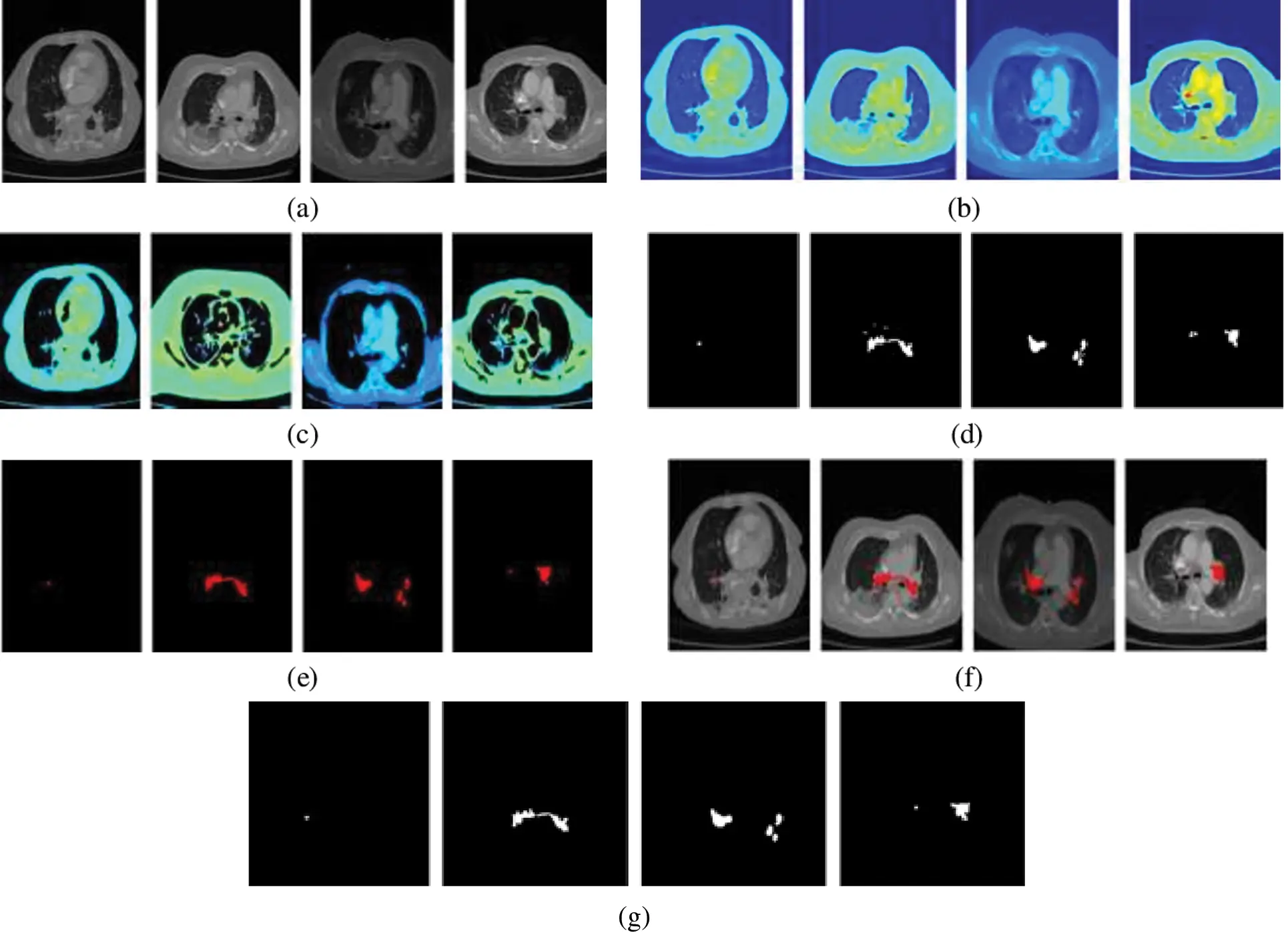 A Novel Deep Learning Framework for Pulmonary Embolism Detection for Covid-19 Management
