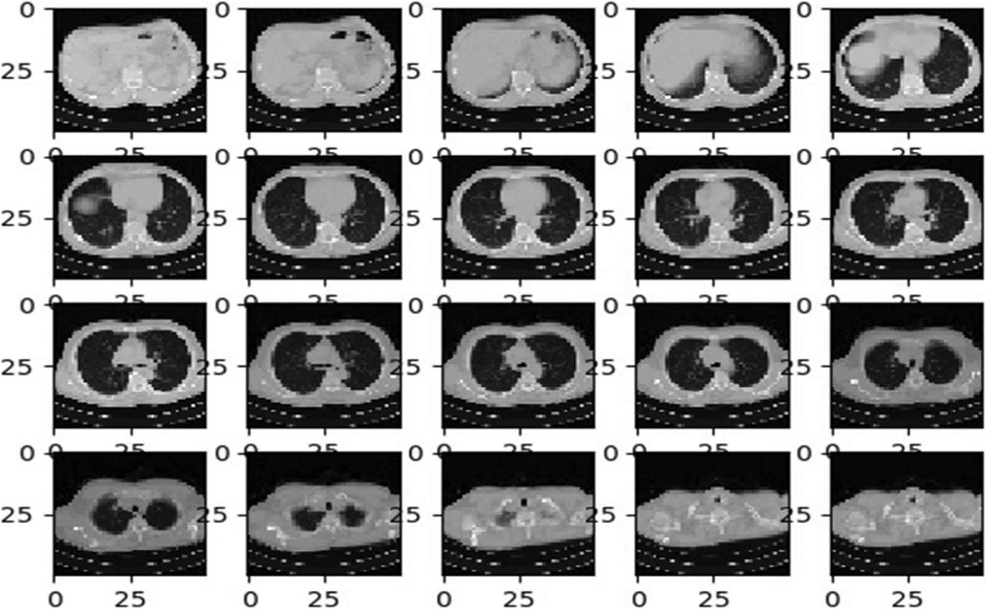 Hybrid Optimized Learning for Lung Cancer Classification