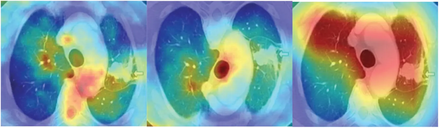 Hybrid Optimized Learning for Lung Cancer Classification