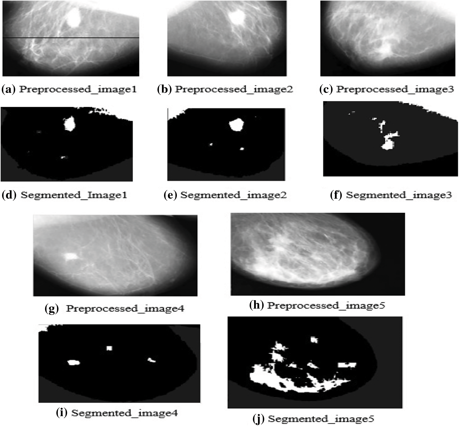 Adaptive Resource Allocation Neural Network-Based Mammogram Image Segmentation and Classification