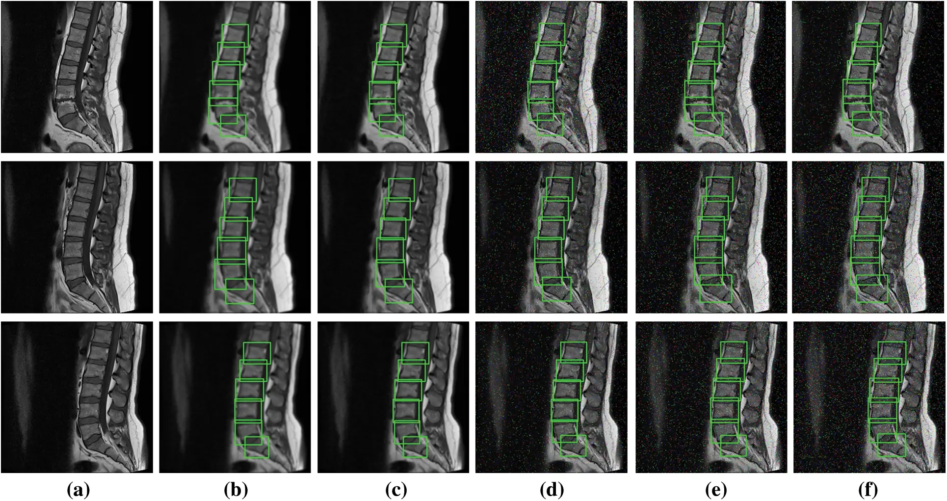 Automatic Localization and Segmentation of Vertebrae for Cobb Estimation and Curvature Deformity