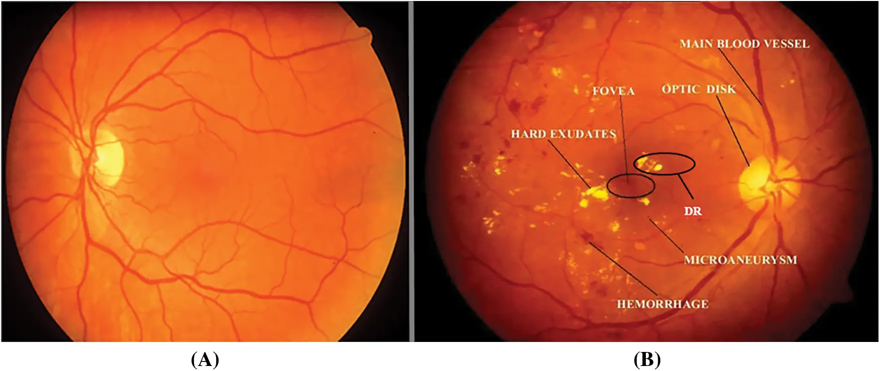 IM-EDRD from Retinal Fundus Images Using Multi-Level Classification ...