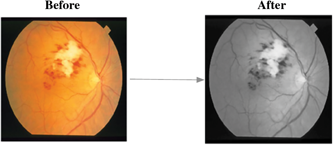 IM-EDRD from Retinal Fundus Images Using Multi-Level Classification ...