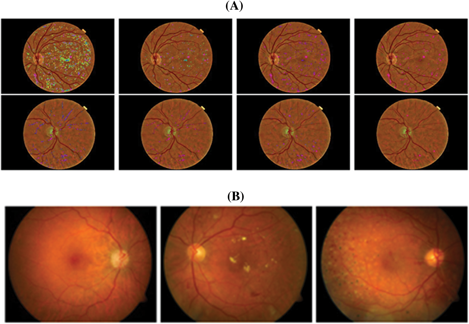 IM-EDRD from Retinal Fundus Images Using Multi-Level Classification Techniques