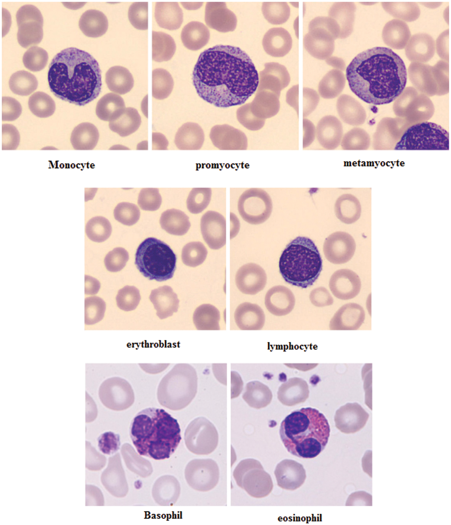 Qualitative Abnormalities of Peripheral Blood Smear Images Using Deep ...