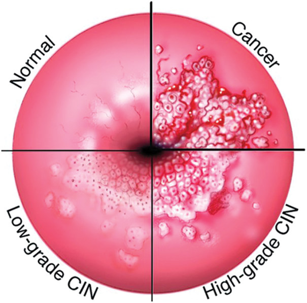IASC | Free Full-Text | Pre Screening of Cervical Cancer Through ...
