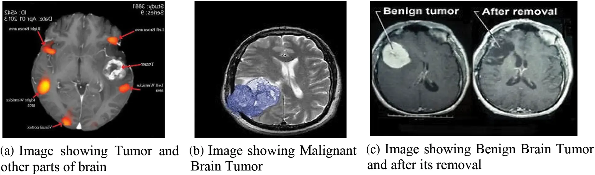 IASC | Free Full-Text | Enhanced Feature Fusion Segmentation for Tumor ...