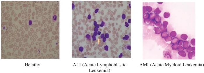 Acute Lymphoblastic Leukemia L1 L2 L3