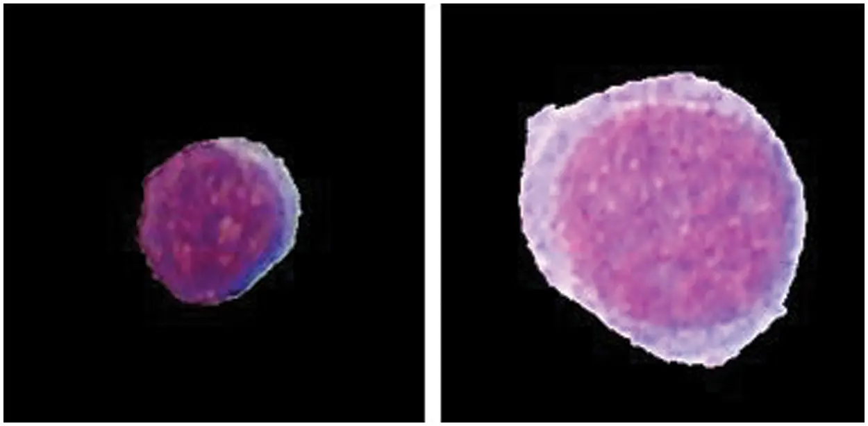 Classification of Bone Marrow Cells for Medical Diagnosis of Acute Leukemia