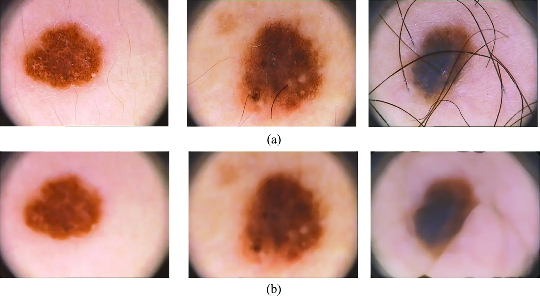 Certain Investigations on Melanoma Detection Using Non-Subsampled ...