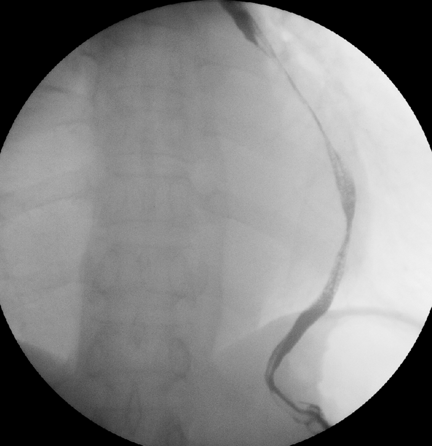 Surgery Combined with Molecular Targeted Therapy Successfully Treated ...