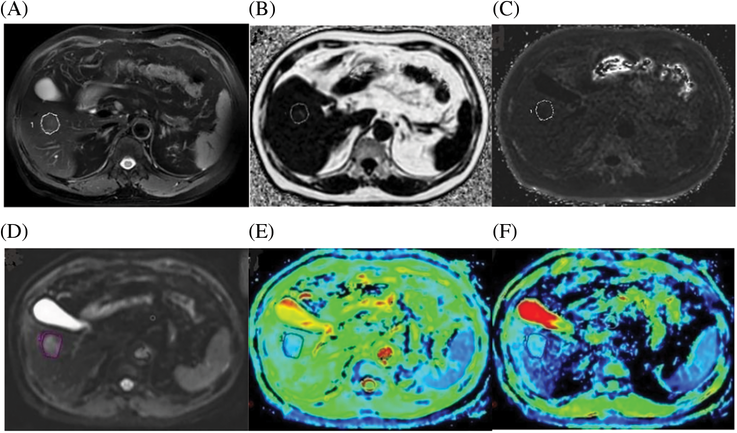 ONCOLOGIE | Free Full-Text | Comparison of IDEAL-IQ and IVIM-DWI for ...