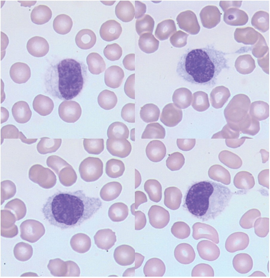 Leucémie à Tricholeucocytes et Autres Proliférations à Cellules ...