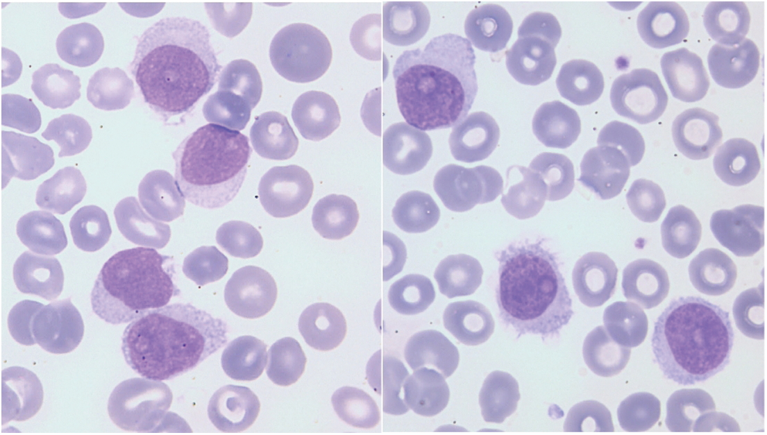 Leucémie à Tricholeucocytes et Autres Proliférations à Cellules ...