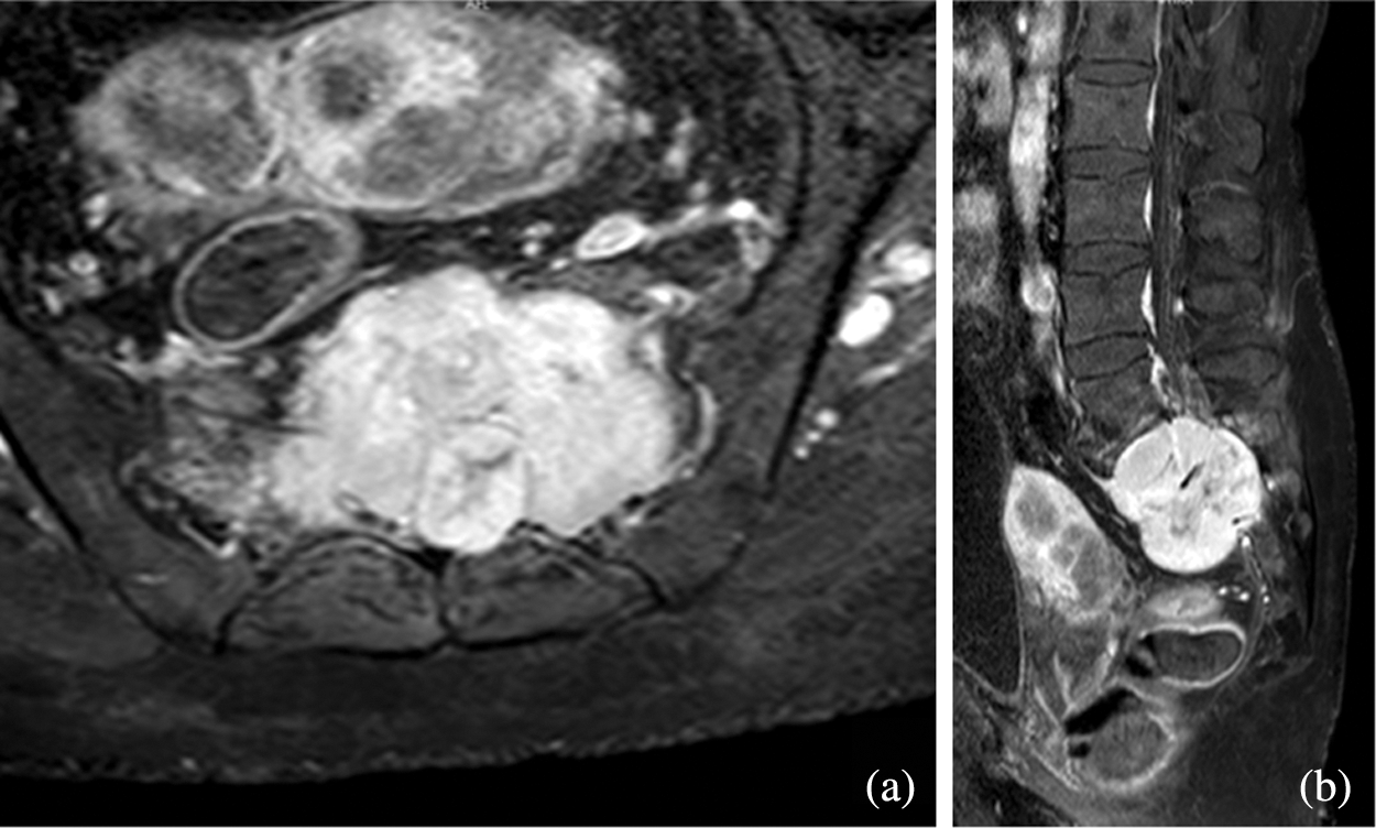 A Primary Sacral Melanoma of Unknown Origin: A Case Report